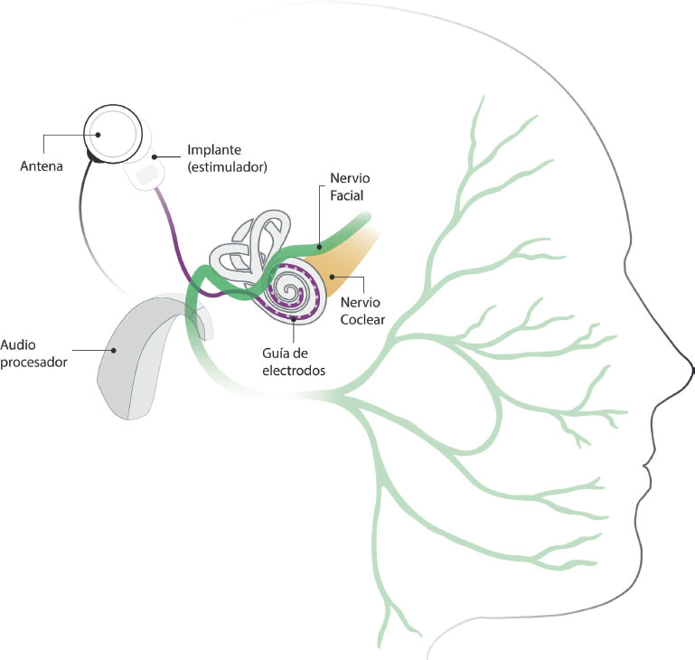 Abordaje clínico de la estimulación facial en implantes cocleares